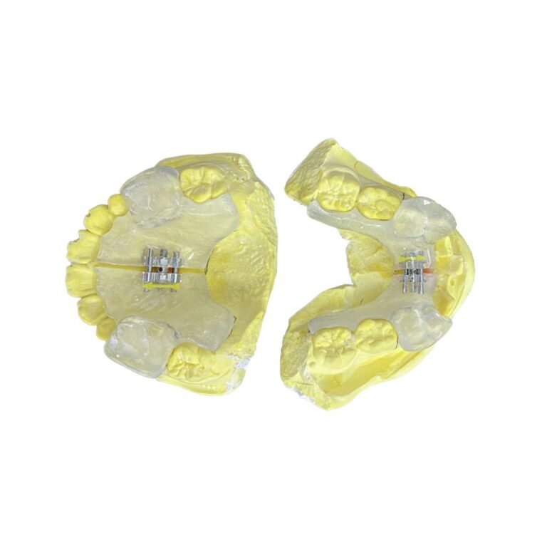 Khí cụ TWIN BLOCK ngược cải tiến 2 ốc nong tháo lắp vòm nhựa